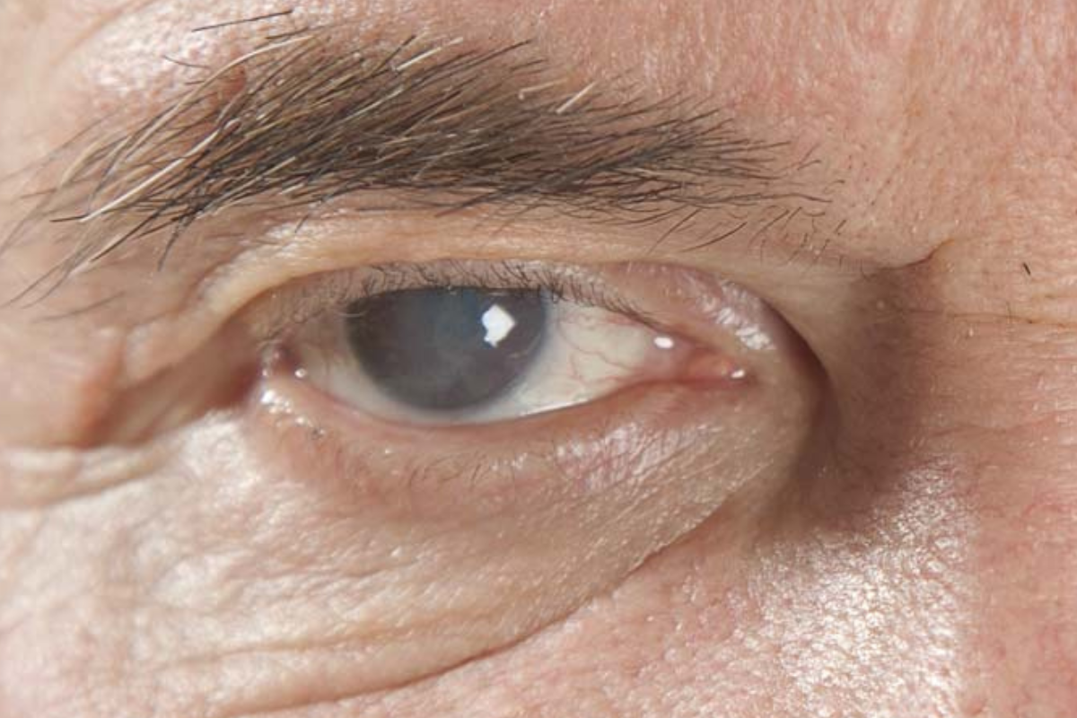 10 common myths about cataracts & cataract surgery